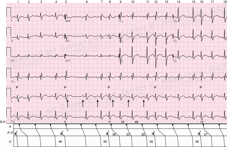 Retrograde concealed conduction | ECG Guru - Instructor Resources